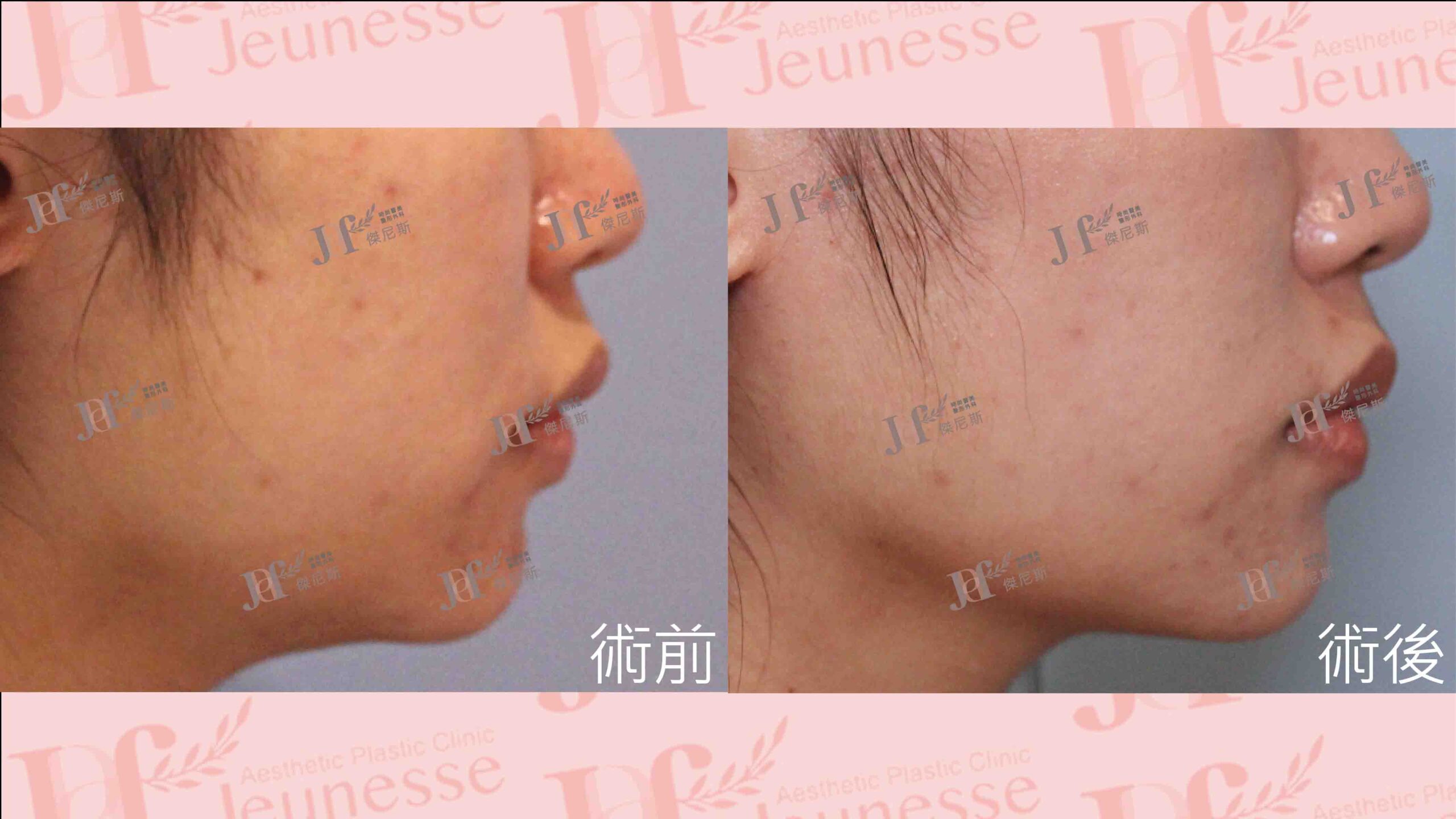 LSSA臉部精雕_0850401A-4-logo | 傑尼斯醫美