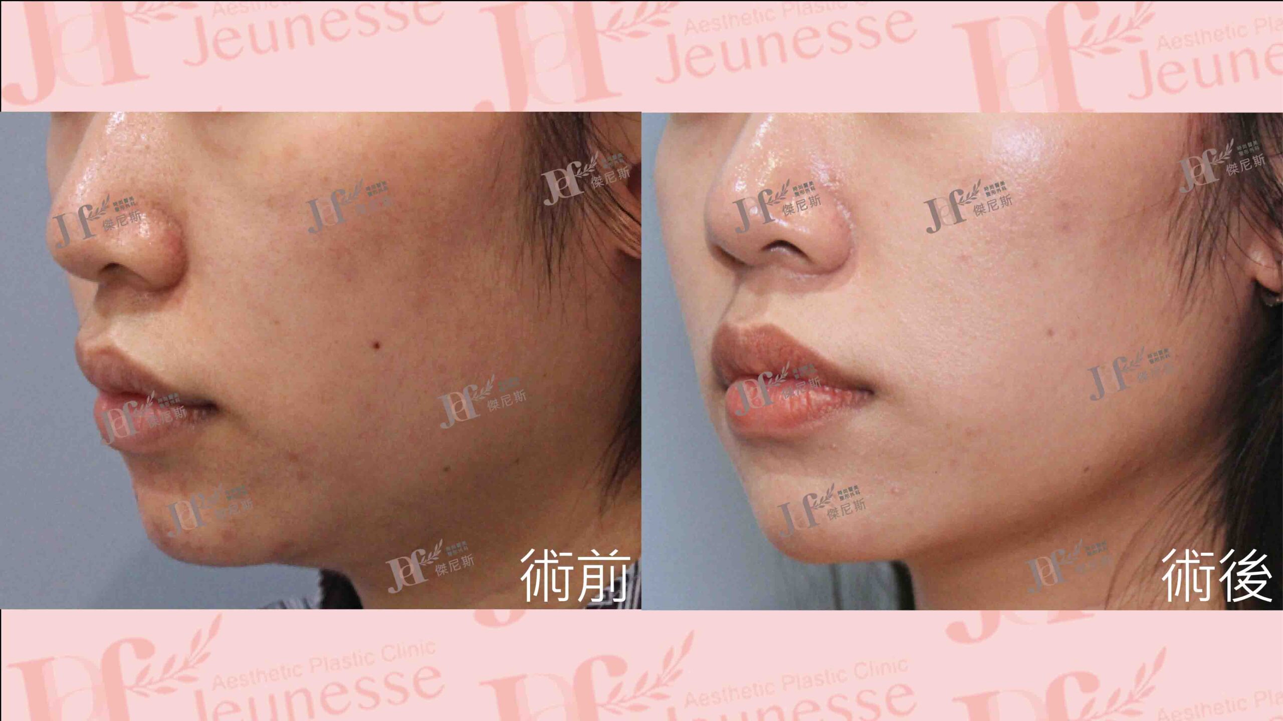 LSSA臉部精雕_0850401A-5-logo | 傑尼斯醫美