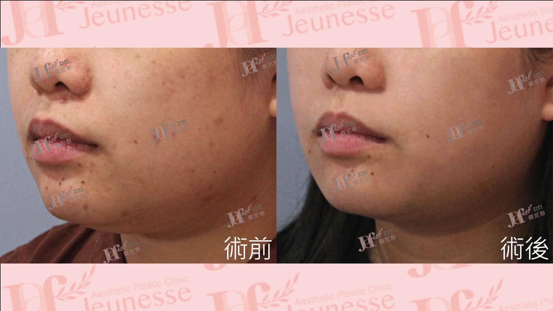 LSSA臉部經雕＋天鵝頸-3-logo | 傑尼斯醫美