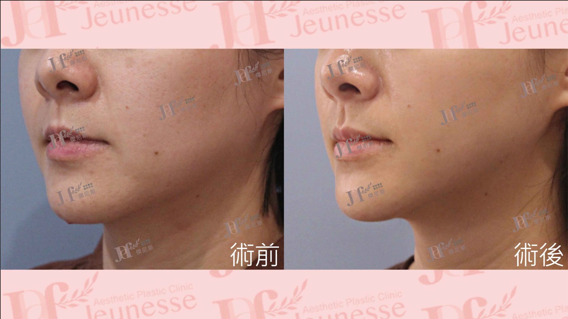 LSSA臉部經雕_-2-LOGO | 傑尼斯醫美