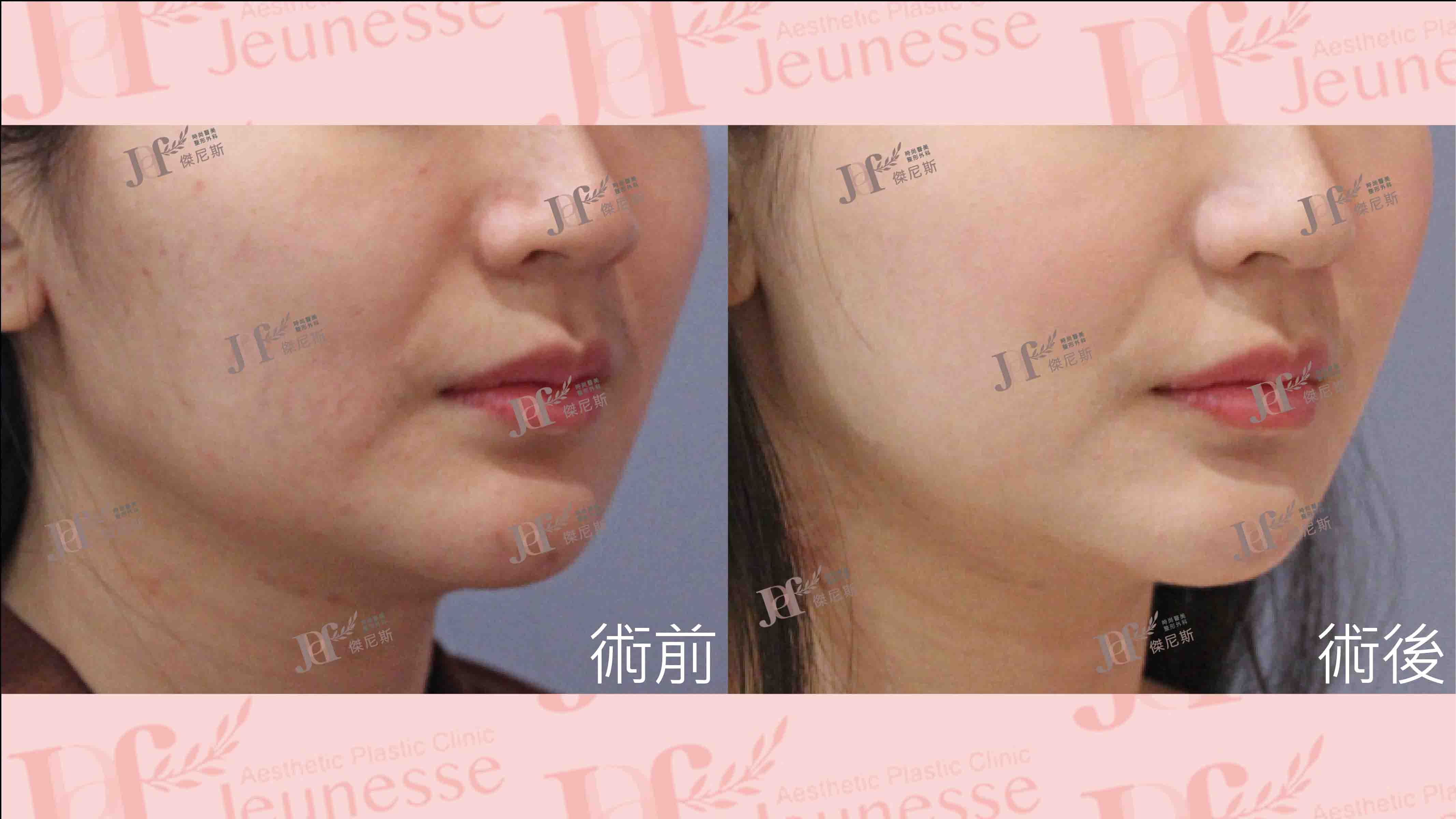 「超音波溶脂」— LSSA天鵝頸手術消除雙下巴 | 傑尼斯醫美