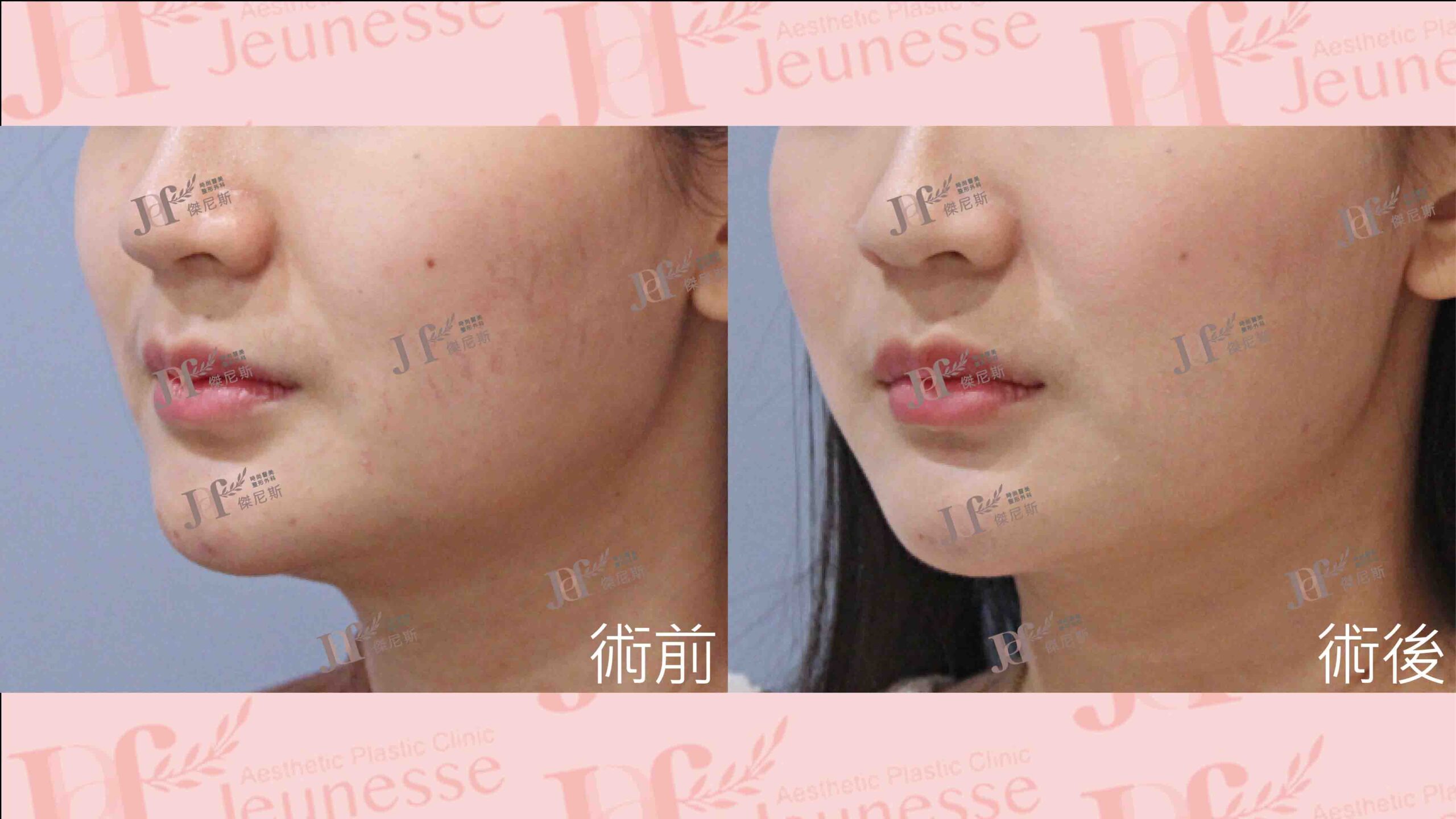 LSSA臉部經雕_-3-logo | 傑尼斯醫美