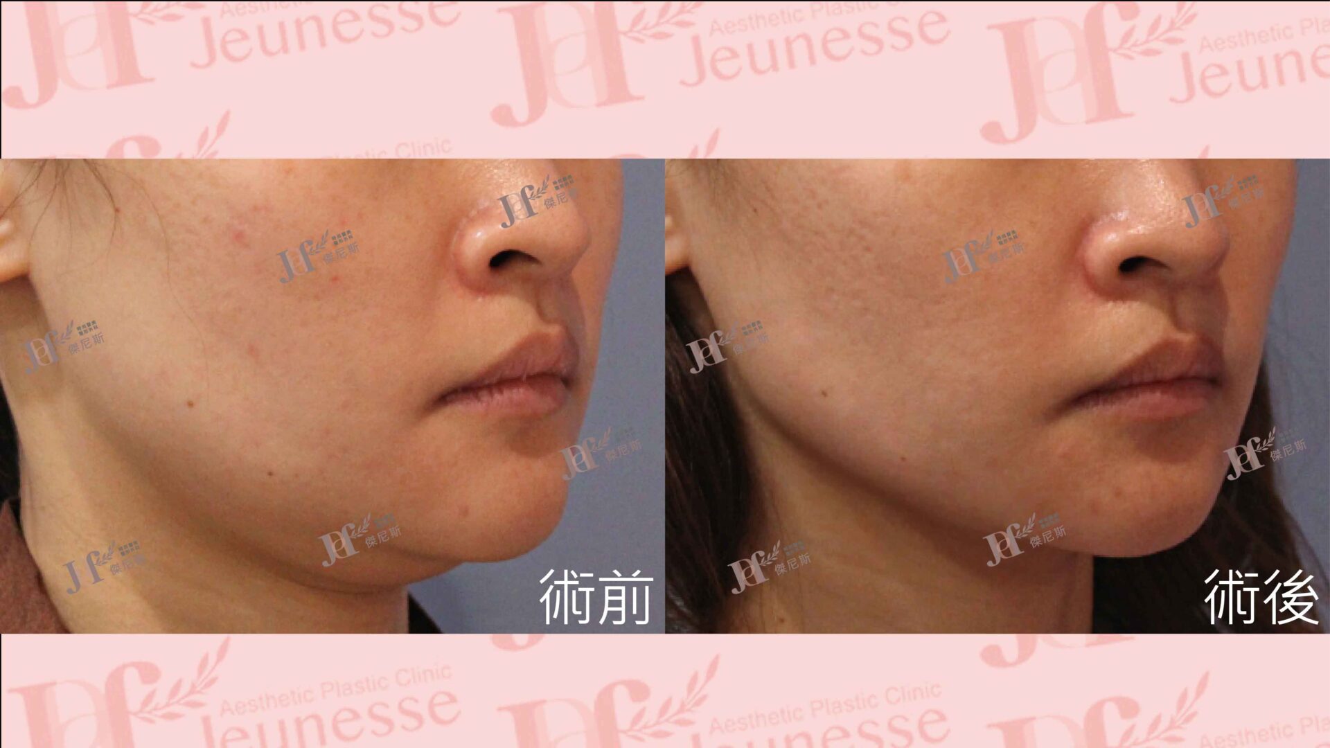 LSSA天鵝頸0771020-03-logo-01 | 傑尼斯醫美