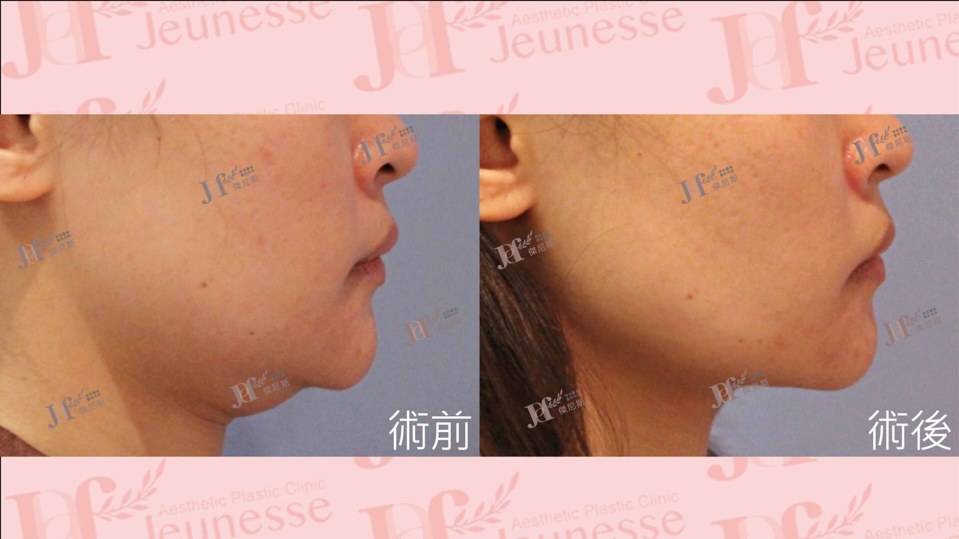 LSSA天鵝頸0771020-05-logo-01 | 傑尼斯醫美