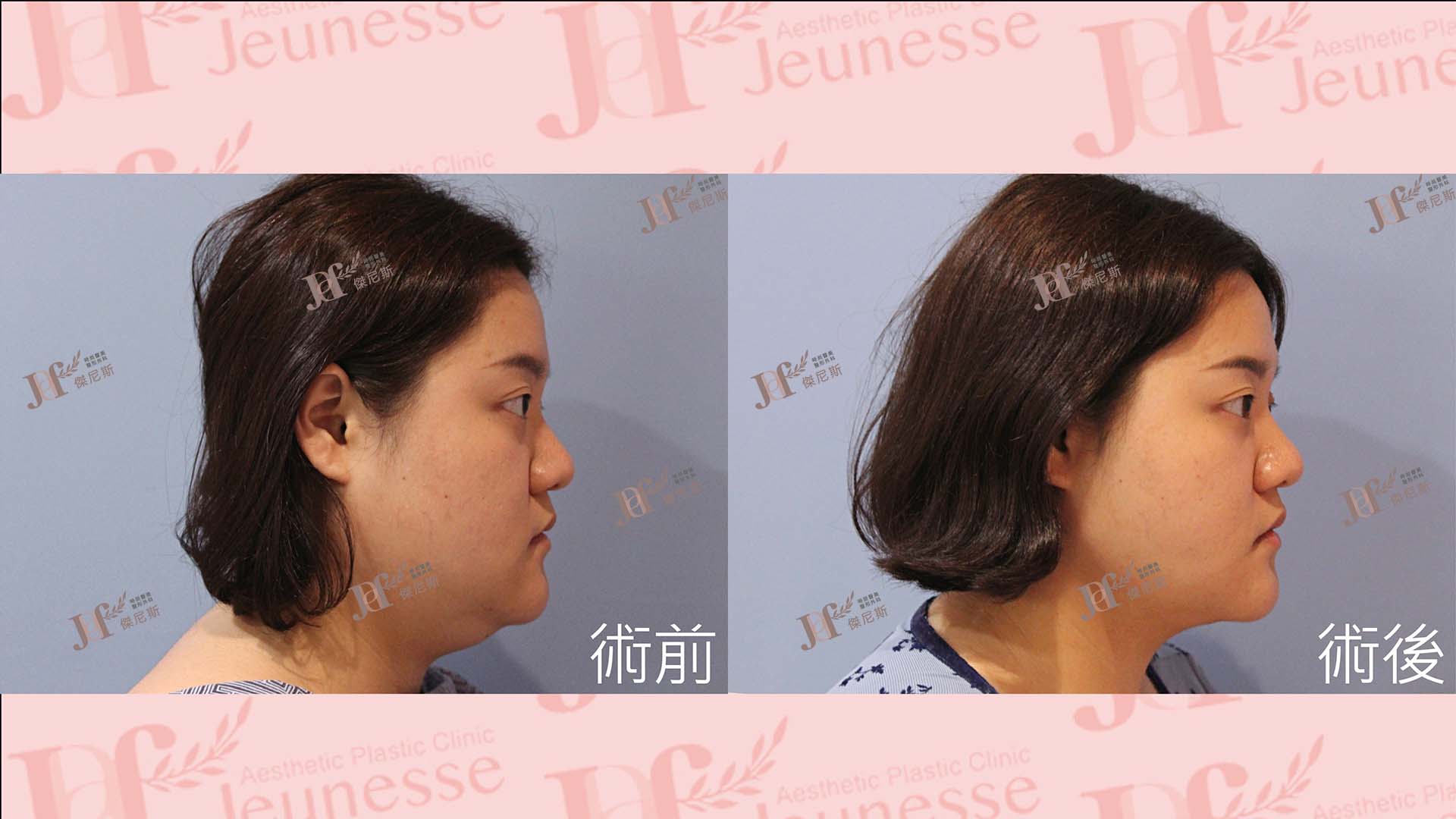 LSSA天鵝頸＋LSSA臉部精雕_0890215-05-logo-01 | 傑尼斯醫美