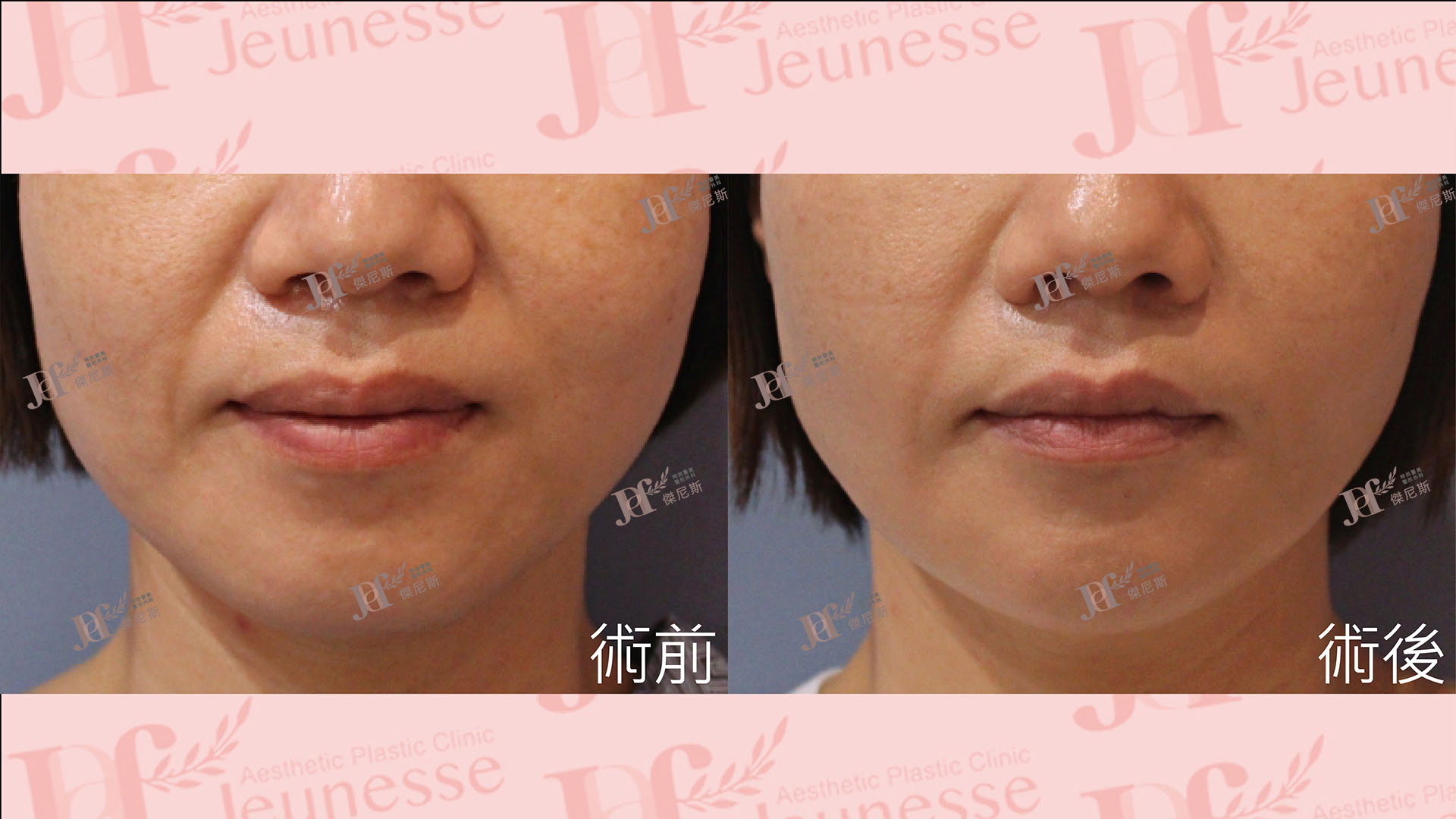 LSSA臉部精雕_0690606-logo-01-01 | 傑尼斯醫美