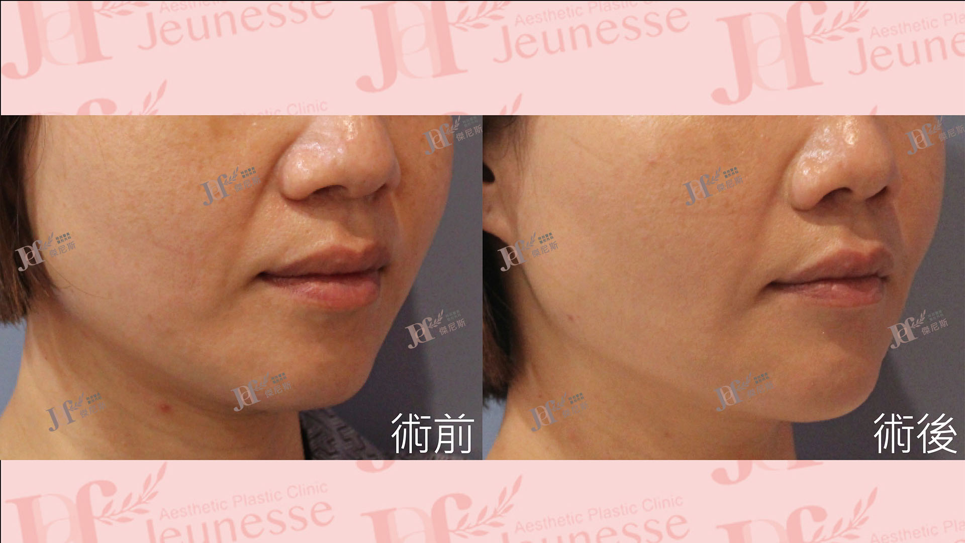 LSSA臉部精雕_0690606-logo-03-01 | 傑尼斯醫美