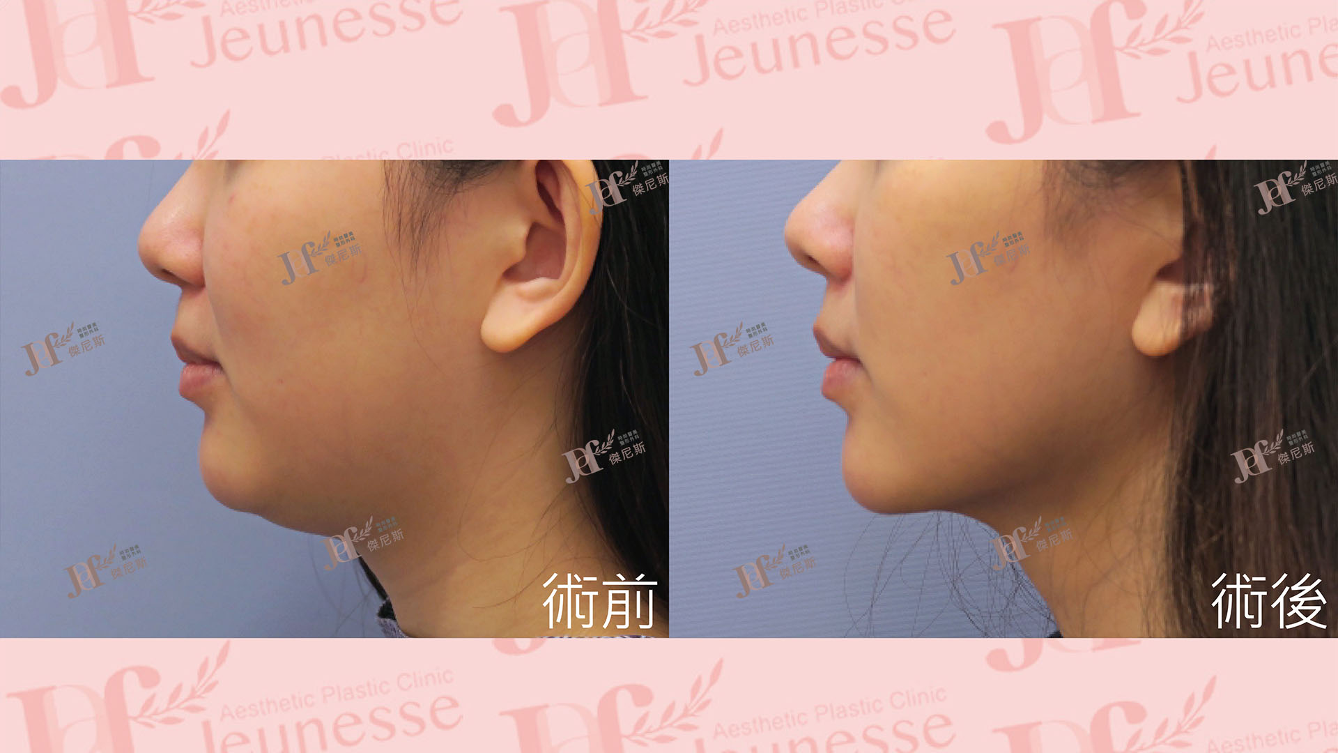 LSSA天鵝頸_830901_logo-02 | 傑尼斯醫美