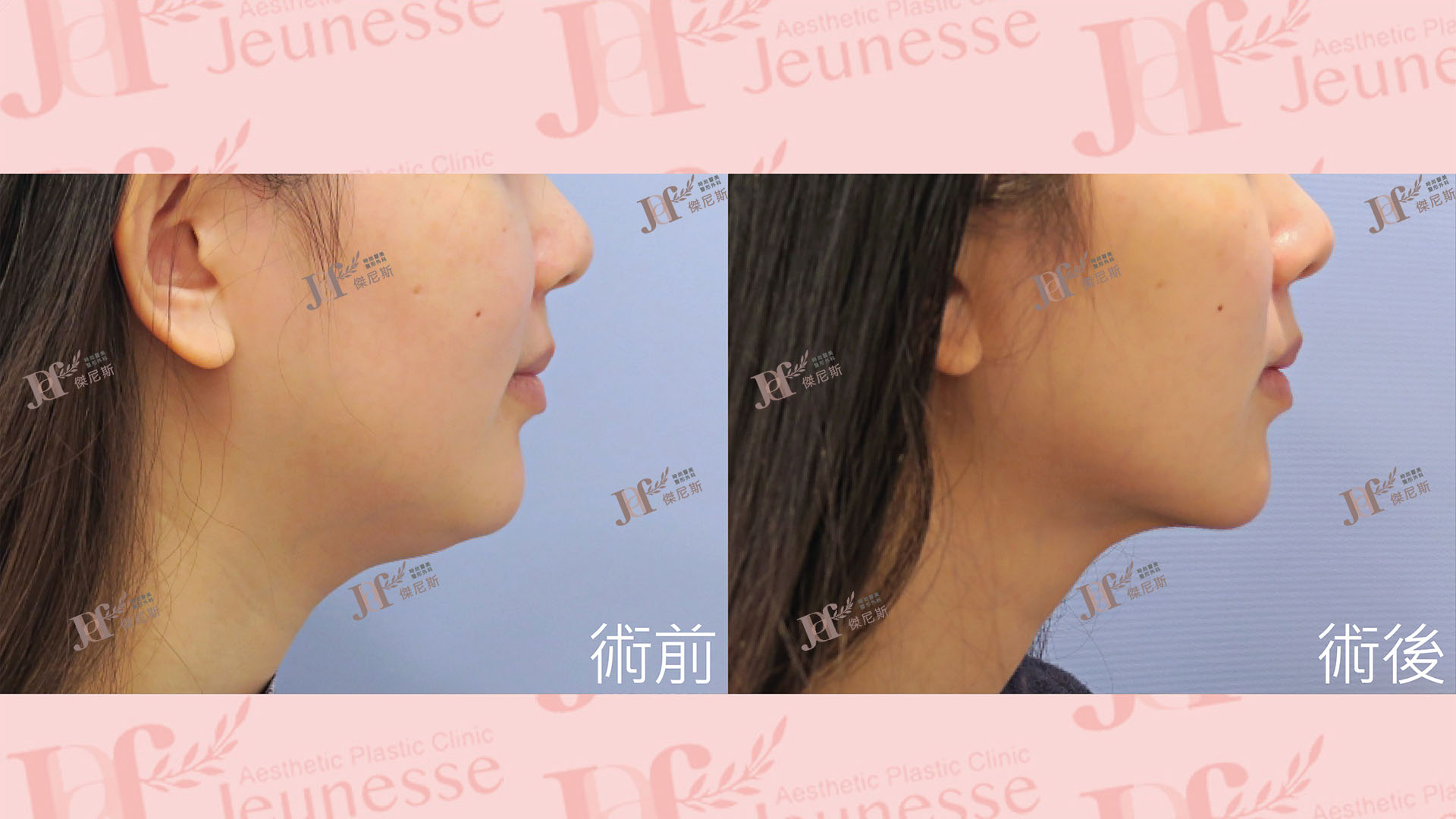 LSSA天鵝頸_830901_logo-03 | 傑尼斯醫美