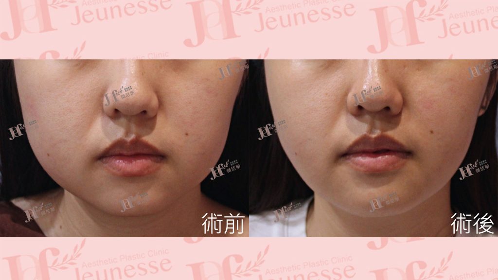 「超音波溶脂」— LSSA天鵝頸手術消除雙下巴 | 傑尼斯醫美