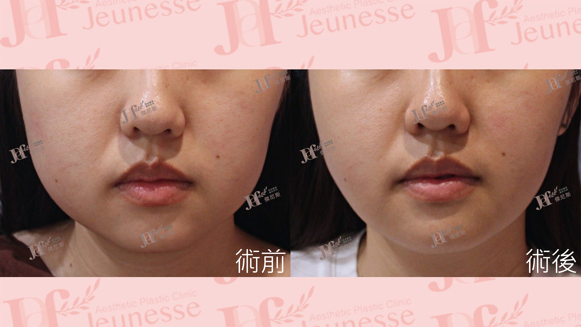 LSSA臉部精雕_830725_logo-01 | 傑尼斯醫美