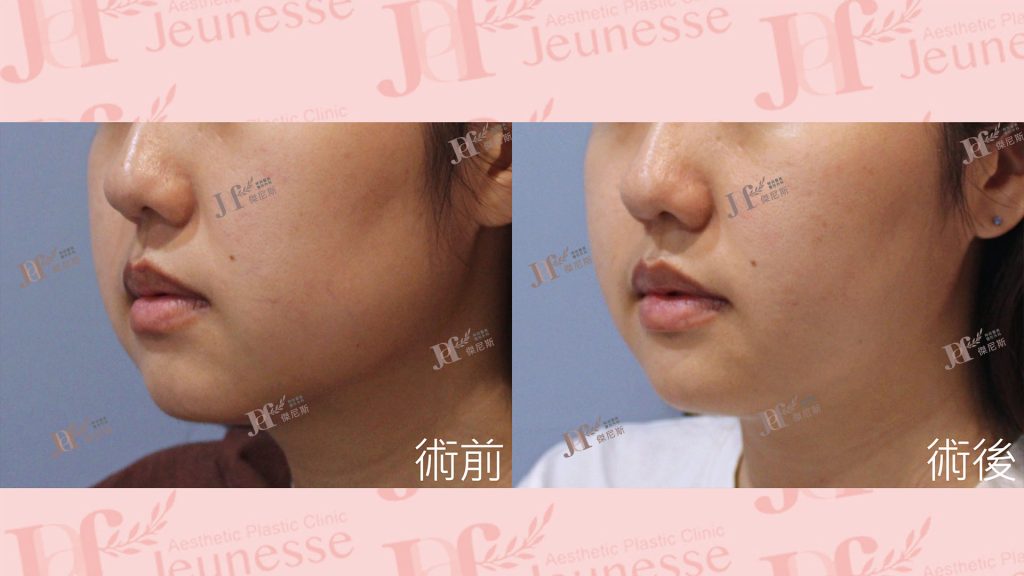 「超音波溶脂」— LSSA天鵝頸手術消除雙下巴 | 傑尼斯醫美